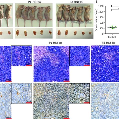 The Roles Of Both P1 And P2 Hnf4a On Gastric Cancer Gc Progression In