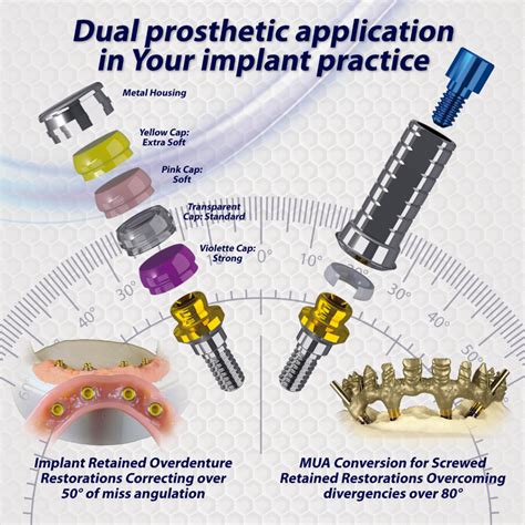Ot Equator Prosthetics Restorations Rhein83