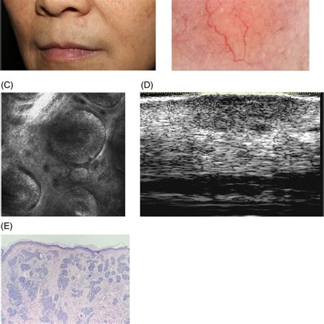A Bright Tumor Island Red Arrows B Epidermal Polarization C