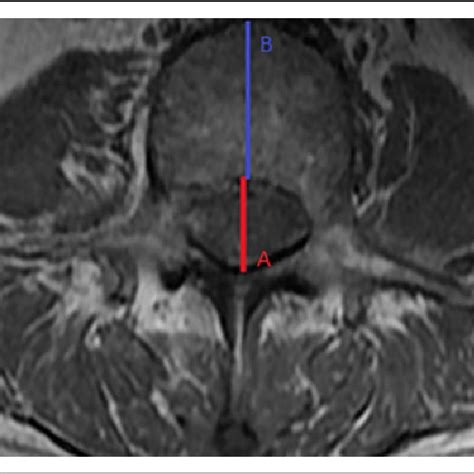 Measurement Of Midline Anteroposterior Ap Spinal Canal Diameter At L1