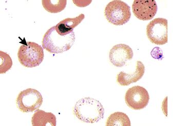 Hematology Flashcards Quizlet