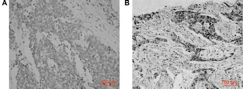 Expression Of P Glycoprotein In Normal Cervical Tissues And Cervical