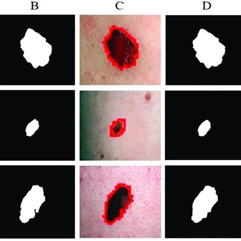 Melanoma Segmentation Results Of Dermquest Dataset From The Skin With Download Scientific