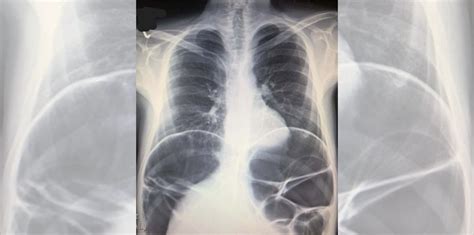 The Most Interesting Medical Cases Of Crohn Disease And Colitis Figure 1