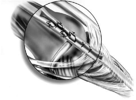 Figure 1 From Surgical Correction Of Extensor Tendon Subluxation And