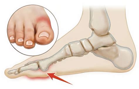 Turf Toe Treatment In Los Angeles Dr Bob Baravarian Dpm Best