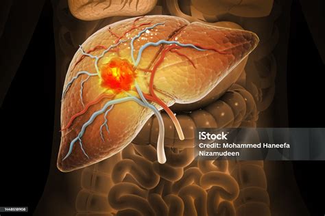 간암 간세포 암종 상태 원인 및 치료 3d 그림 암종에 대한 스톡 사진 및 기타 이미지 암종 황달 간염 Istock