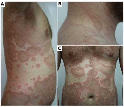Toxocara Canis Rash