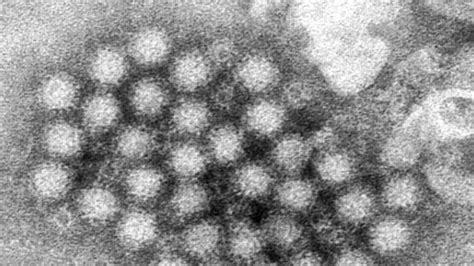 Norovirus Outbreaks In Us Why Doesnt Hand Sanitizer Kill This Virus