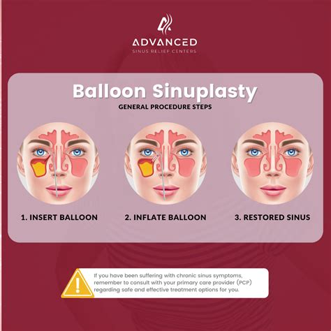 Why Balloon Sinuplasty Is So Effective Advanced Sinus Relief Centers