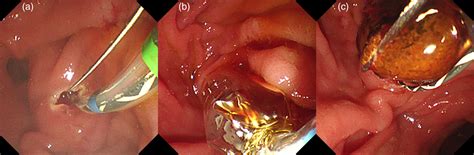 Journal Of Hepato Biliary Pancreatic Sciences Vol 32 No 2