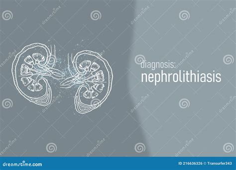Nefrolitiasis Cálculos Renales Enfermedad O Urolitiasis Cálculo Renal