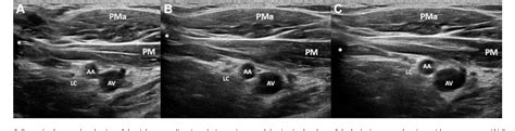Figure 9 From Pectoralis Minor Syndrome E Review Of Pathoanatomy