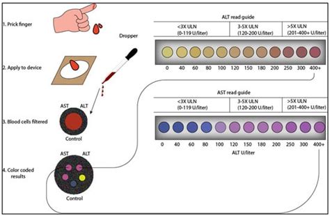 Low Cost Point Of Care Monitoring Of Alt And Ast Is Promising For Faster Decision Making And