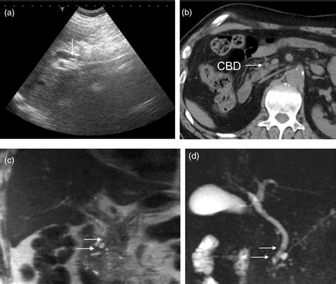 Tokyo Guidelines 2018 Diagnostic Criteria And Severity Grading Of Acute Cholangitis With Tokyo Guidelines 2018 Diagnostic Criteria And Severity Grading Of Acute Cholangitis With