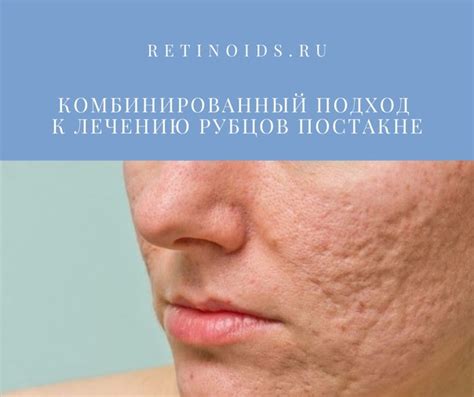 [ИССЛЕДОВАНИЕ] КОМБИНИРОВАННЫЙ ПОДХОД К ЛЕЧЕНИЮ РУБЦОВ ПОСТАКНЕ Рубцы
