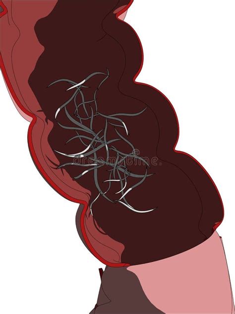 Colon With Adult Pinworms Stock Vector Illustration Of Cross 9679413