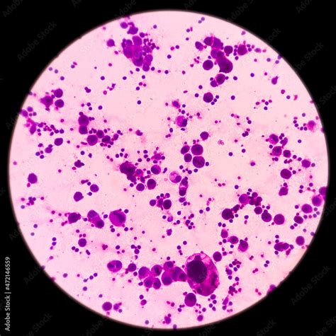 Malignant Cells Cancer Cells Pleural Fluid Cytology Of Lung Metastatic Adenocarcinoma