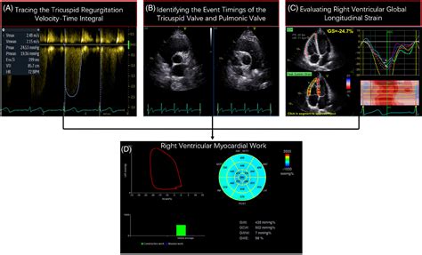 Correlations Among Noninvasive Right Ventricular Myocardial Work Indices And The Main Parameters
