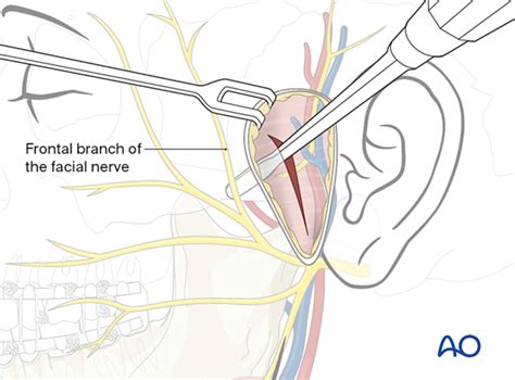 Preauricular Approach