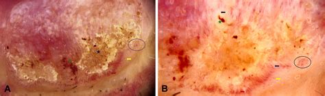 Diagnosing Squamous Cell Carcinoma Of The Lip Using Dermoscopy Journal Of The American Academy