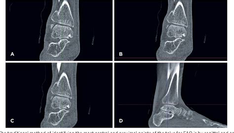 Figure 1 From Foot And Ankle Offset In The Setting Of Severe Rotational