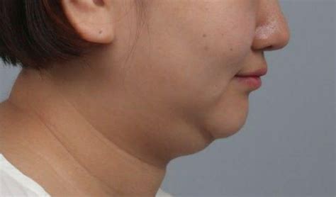 파워v얼굴지방흡입 실리프팅 이중턱근육묶기 후기 닥터정 리반의원