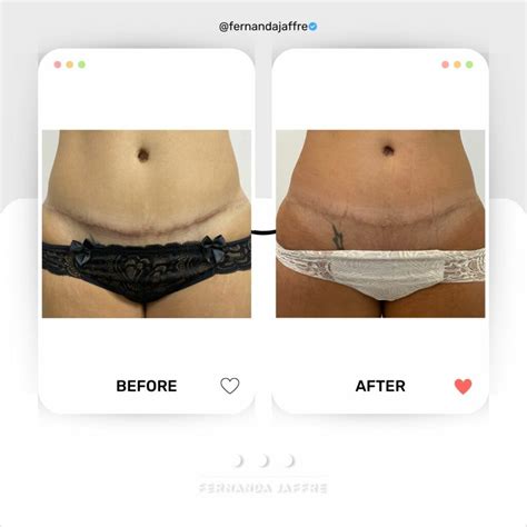 Scar Tattoos All About Tummy Tuck Scar Tattoo Fernanda Jaffre