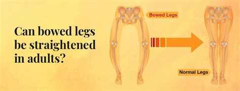 Knock Knees Causes Treatment And Best Exercises 2023