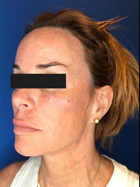 Pdo Lower Face Banda Patient 11 Biltmore