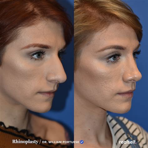 Rhinoplasty The Ultimate Guide To A Nose Job Realself Rhinoplasty Nose Jobs Rhinoplasty