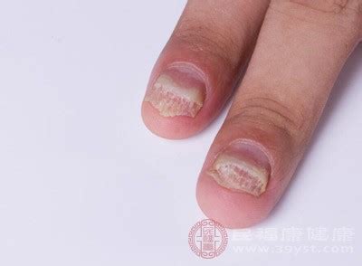 灰指甲的初期症状 灰指甲早期照片 随意云
