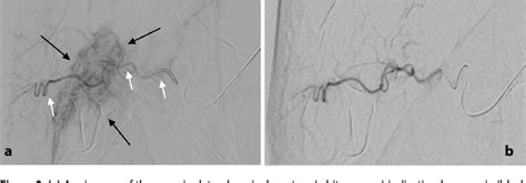 Figure 2 From Review Of Genicular Artery Embolization Radiofrequency