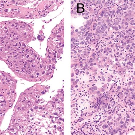 Intraoperative Frozen Section A The Middle Lobe Tumor Composed Of