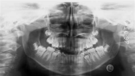 Orthodontic Update Linear Scleroderma ‘en Coup De Sabre And An