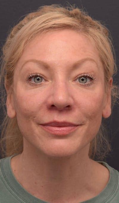 Lip Lift Before And After Photos Robb Facial Plastic Surgery