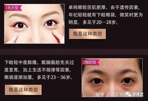 科普眼袋的秘密 知乎