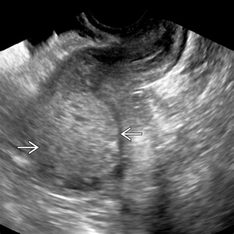 Endometrial Carcinoma Radiology Key