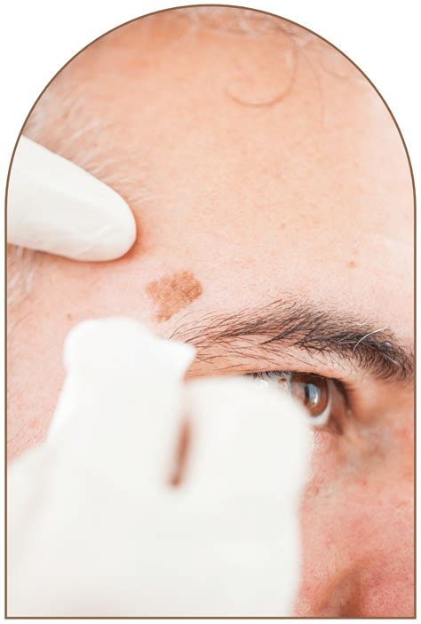 Surgical Excision Near Chicago Il Skin Md Llc