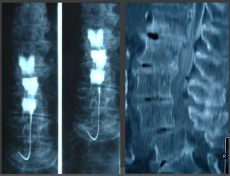 Neuroimaging Lecture Images Flashcards Quizlet
