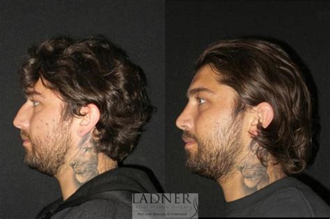 Celebrity Nose Jobs Before And After Profile