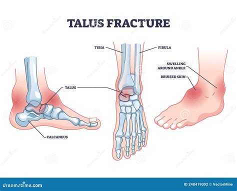 Talus Fracture And Broken Leg With Swelling Ankle Symptom Outline