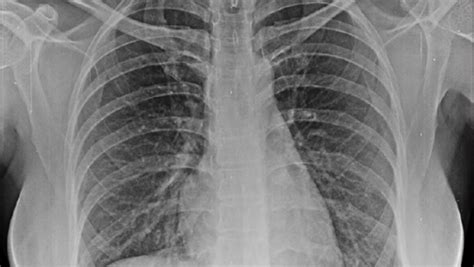 Best Of 2023 Acr Guidelines For Interstitial Lung Disease In Patients With Rheumatic Conditions