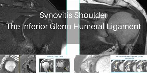 Mri Synovitis Specific Sites In The Shoulder The Inferior Glenohumeral