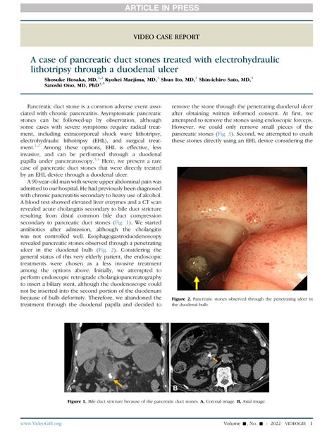 Pdf A Case Of Pancreatic Duct Stones Treated With Electrohydraulic Lithotripsy Through A