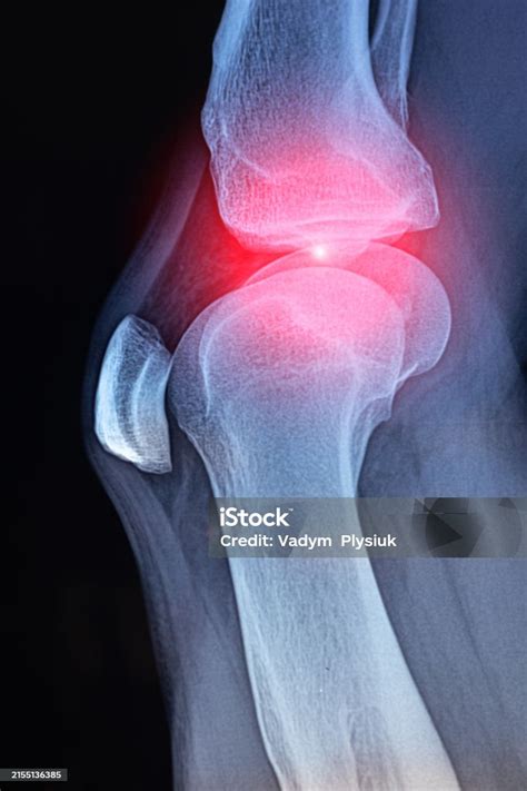 Osteoid Osteoma Benign Bone Tumor Xray And Mri Mrt Ct With Marked
