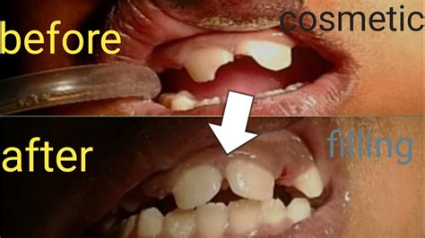 Composite And Amalgam Dental Filling Procedure Dental Clinic