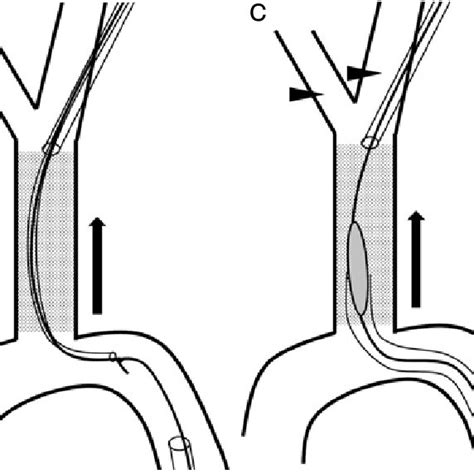 llustrations of combined endovascular antegrade and direct retrograde