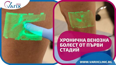 Хронична венозна болест от първи стадий Youtube
