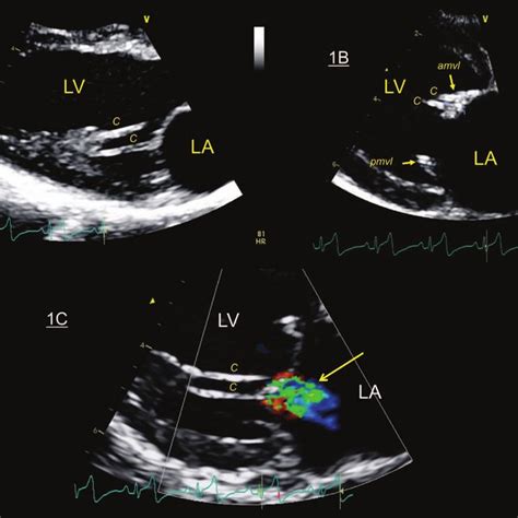 A C Two Dimensional A B And Color Flow Doppler Mode C Download Scientific Diagram